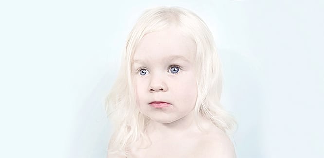 Was ist albino? Ursachen, Symptome und Behandlung von Albinismus