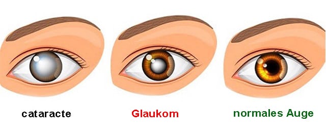 Glaukom (Grüner Star): Ursachen, Symptome und Behandlung